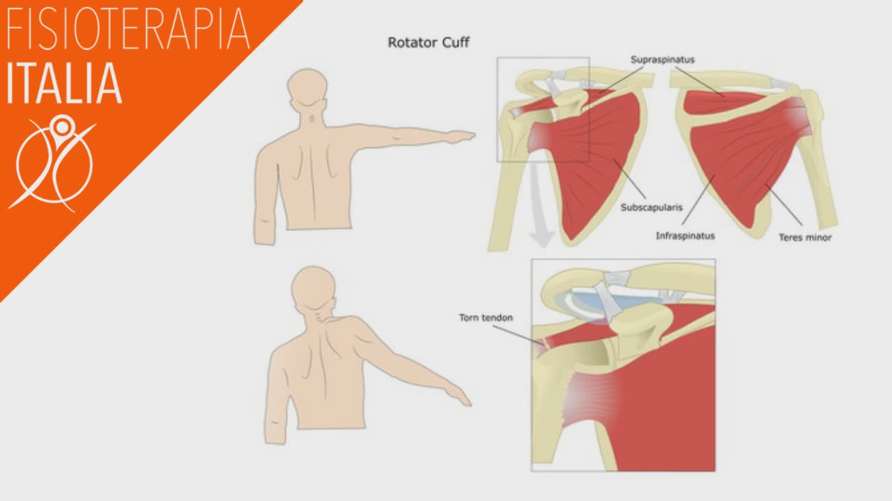 cuffia dei rotatori, patologia e cura