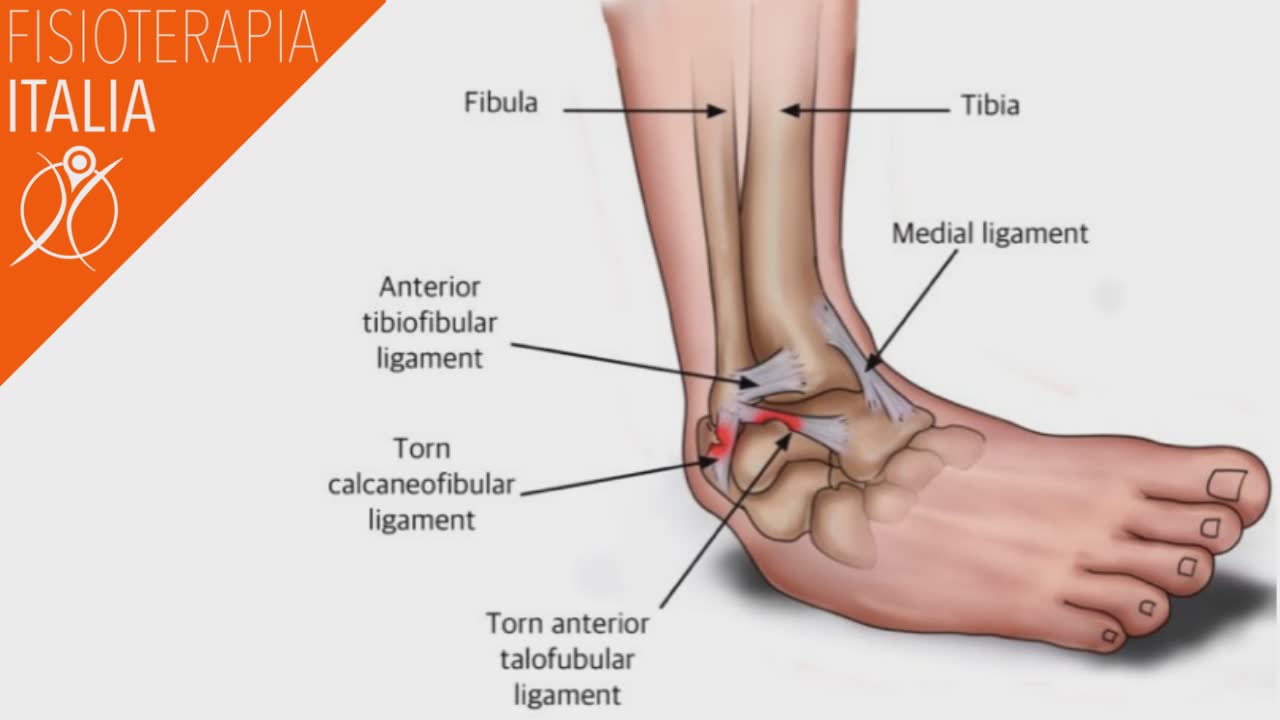 Dolore alla caviglia cosa fare appena si presenta