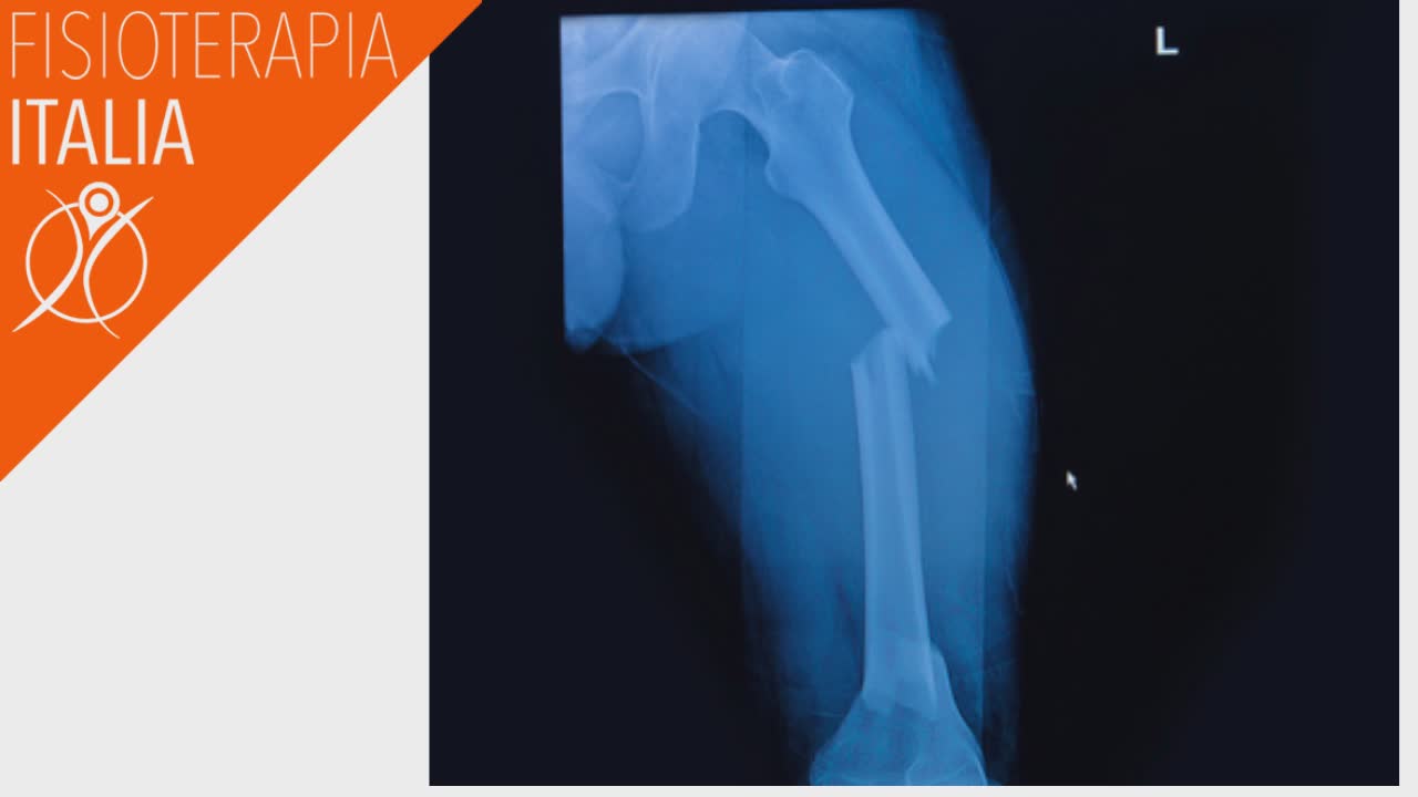 Le fratture del femore cause e cure