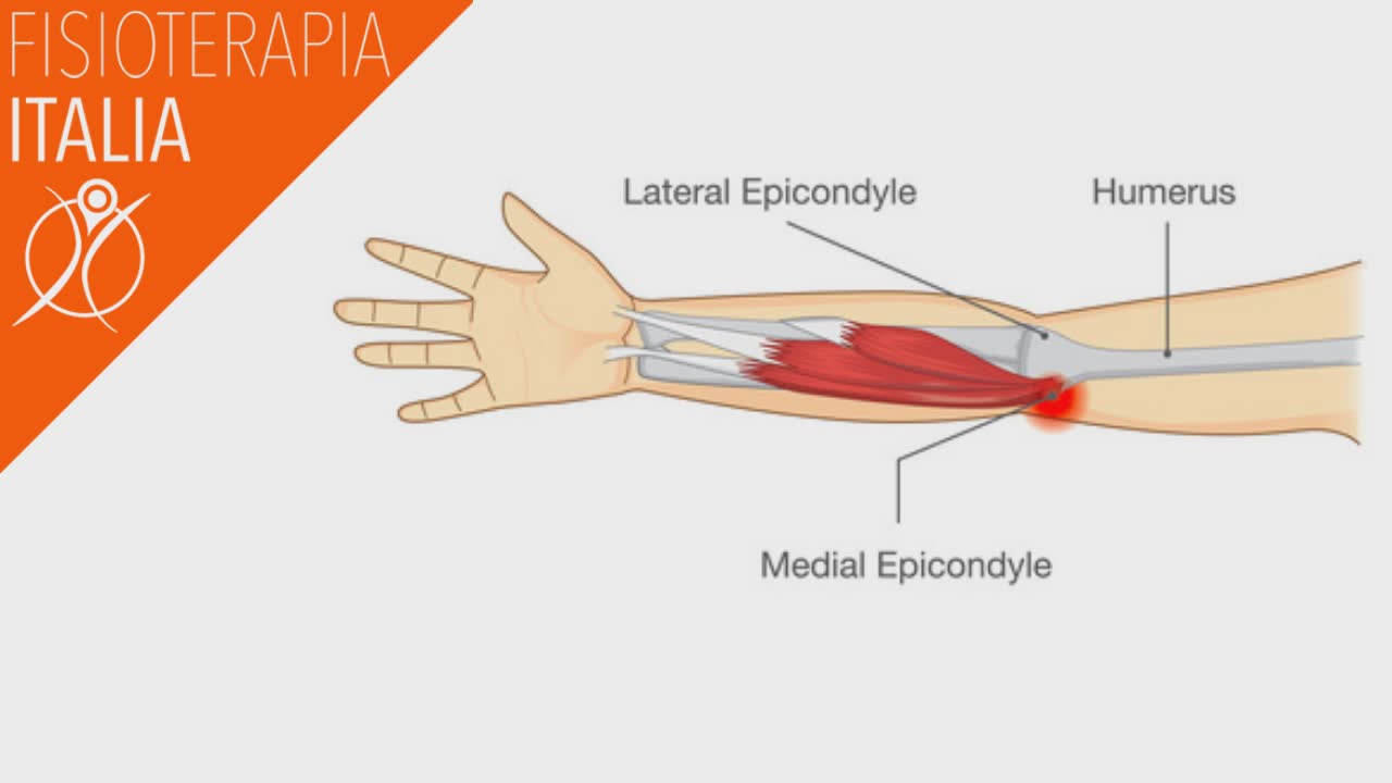Epitrocleite, il gomito del golfista, cause e cure