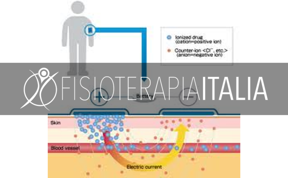 Ionoforesi, tecnica usata in fisioterapia