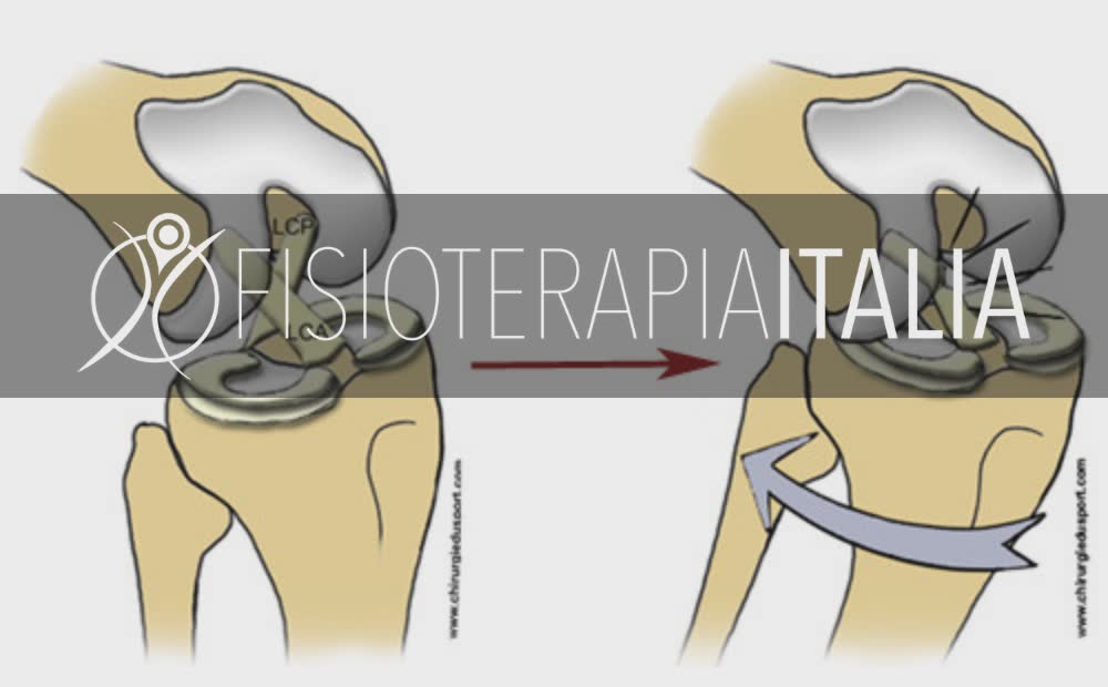 Rottura crociato ginocchio: quando operarsi e la riabilitazione