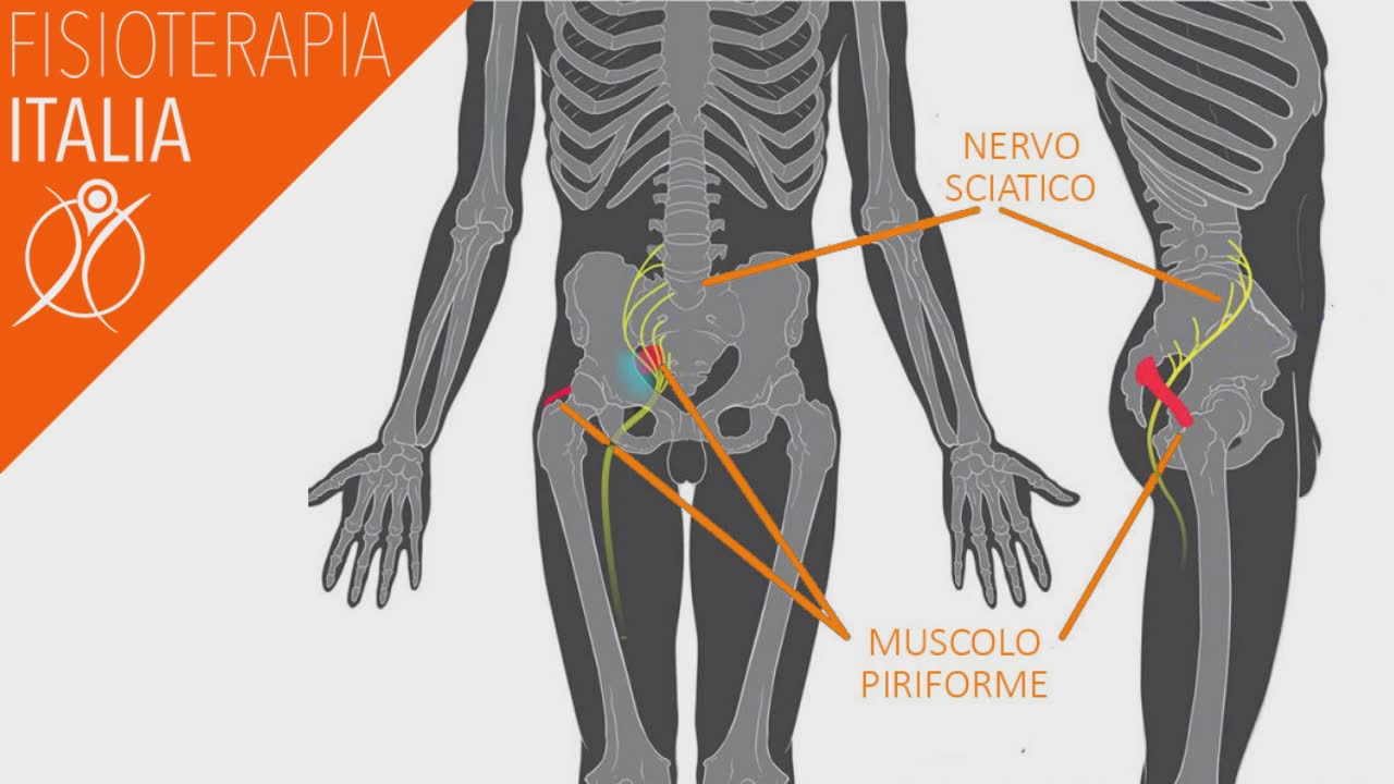Sindrome del Piriforme, cos'è e come si cura