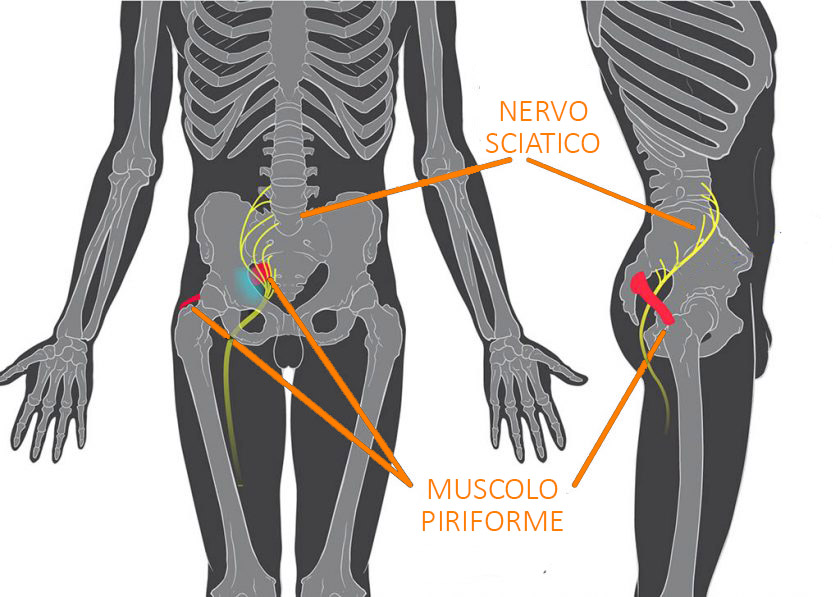 Sindrome del Piriforme, cos'è e come si cura